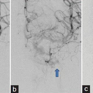 Sequential DSA Images From A L ICA Injection In AP Projection Are Download Scientific Diagram