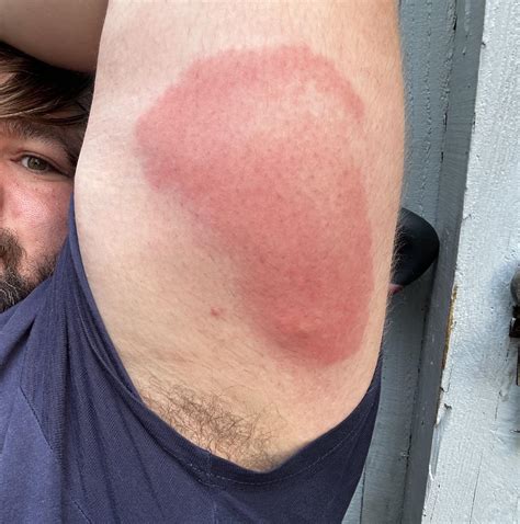Spider Bite Last Night R Popping
