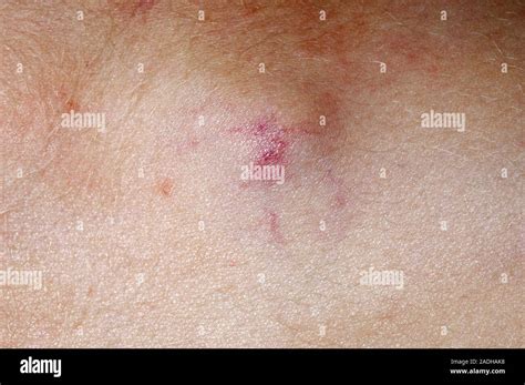 Subcutaneous Calcinosis Calcified Nodule On The Back Of A 7 Ear Old