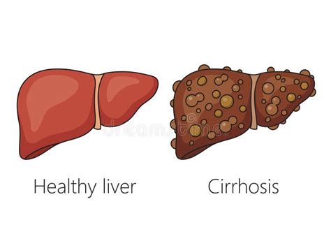 Schema Terapeutică a Bolii Hepatice și Ciroză Sănătoase Stock Vector Ilustrare din uman