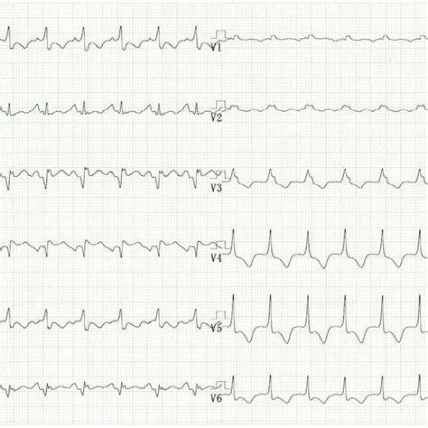 An Electrocardiogram Revealing Inverted T Waves In Precordial Leads