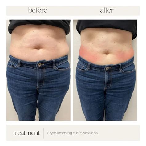 Cryo Slimming Cryo Body Slimming Cryotherapy Slimming In Bromley