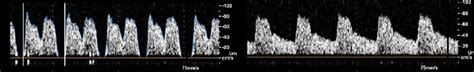 Measurement Of Transcranial Doppler Tcd Flow Velocity Of The Middle