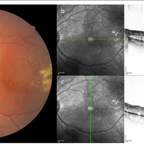 Left And Right Columns Show The Sd Oct Image Of Lattice Degeneration