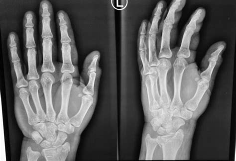 A Young Gentleman Sustained A Closed Fracture De Of Radius Fracture