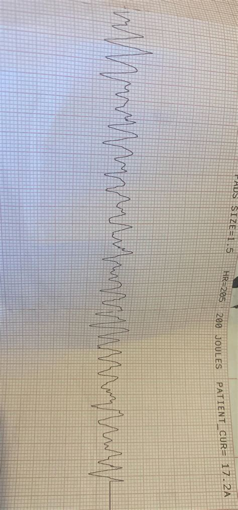 Need Help Ekg Vfib Vs Vtach R Cathlablounge