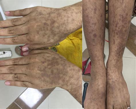 Residual Post Inflammatory Hyperpigmentation On A The Hands B Feet