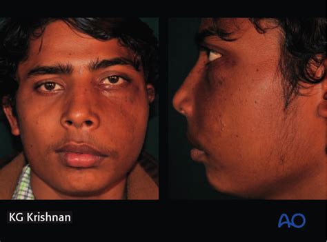 Partial Ostectomy And Contouring For Extensive Fibrous Dysplasia