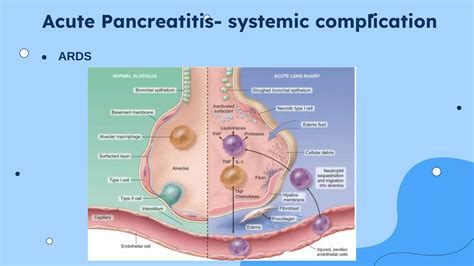 Pancreatitis Complications Pptx Ppt