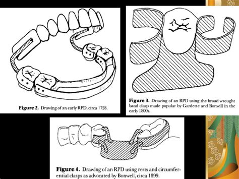 Kennedy Classification Ppt