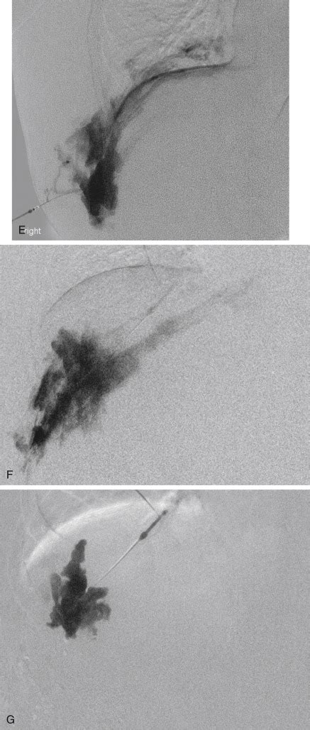 Management Of Low Flow Vascular Malformations Radiology Key
