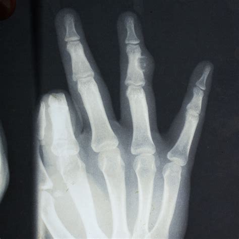 Periosteal Chondroma