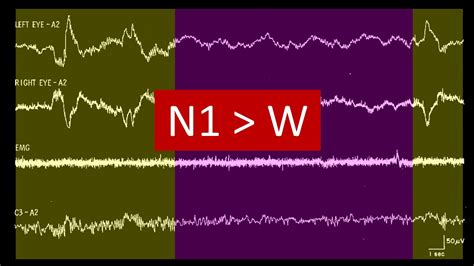 Polysomnography 3 Youtube