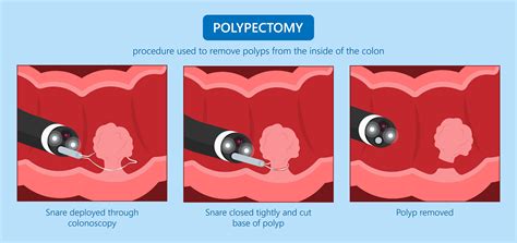 Emr Polypectomy Dubai Gastroenterology Clinic