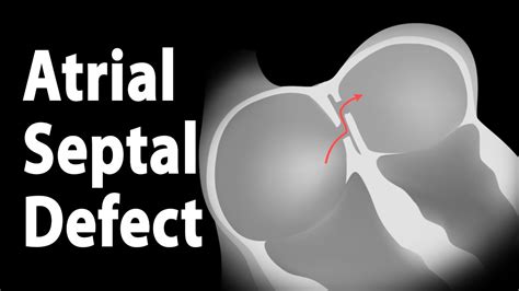 Atrial Septal Defect Types