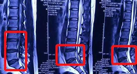 腰椎退行性病变，腰间盘突出是不是最终会瘫痪？ 搜狐大视野 搜狐新闻