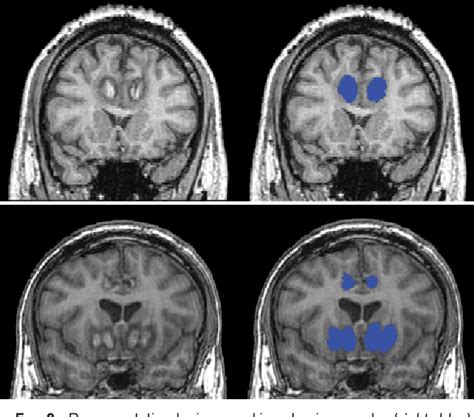 Figure 2 From Lesion Analysis For Cingulotomy And Limbic Leucotomy
