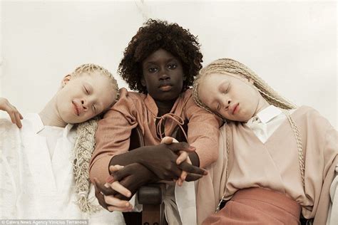 Portraits Of Albinism Letting An Inner Light Shine Artofit