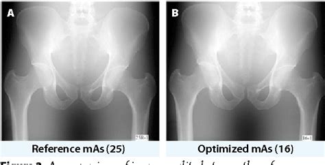 Table 2 From Optimizing The Exposure Indicator As A Dose Management Strategy In Computed