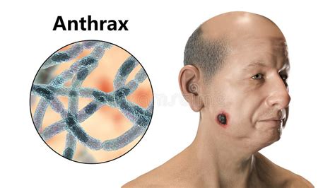 Cutaneous Anthrax The Most Common Form Of Anthrax Stock Illustration