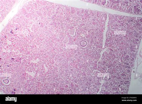 Photomicrograph Of Lobar Pneumonia In Red Hepatic Phase Displaying
