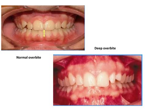 Classification Of Occlusion And Malocclusion Dr Nabil Al Zubair Pdf