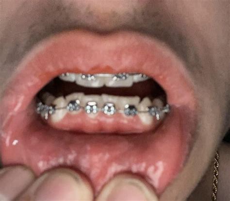 9 Month Progress Update R Braces