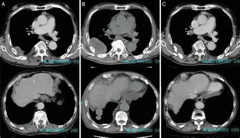 A Primary Tumour On Chest Computed Tomography Ct B Chest Ct Download Scientific Diagram