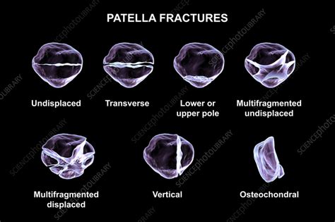 Classification Of Patella Fractures Illustration Stock Image F0442831 Science Photo Library