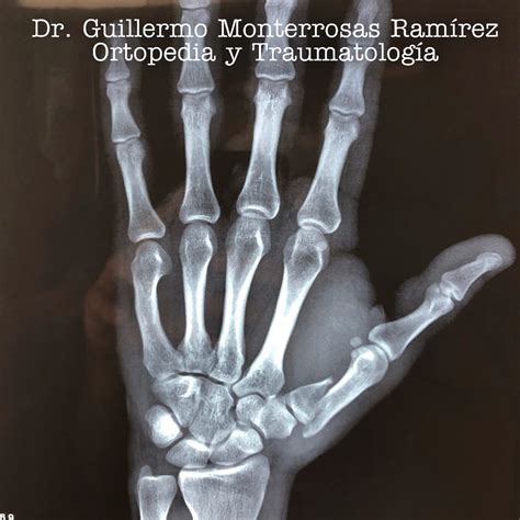 🤓🦴🖐🏽 ¿fractura De Bennet O No Fractura Metafisiaria Proximal De 1er