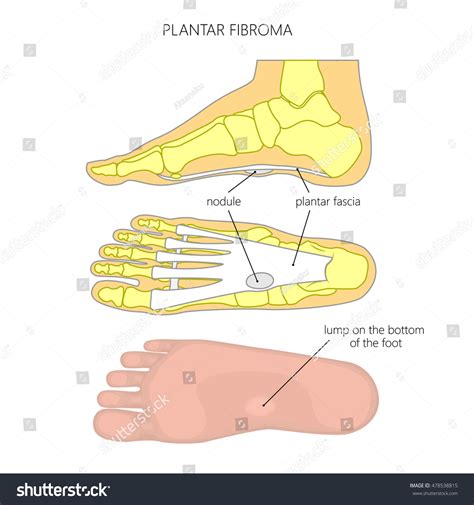 Vector Diagram Plantar Fibroma Fibromatosis Tumor Stock Vector Royalty