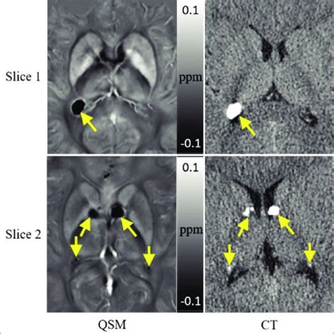 Quantitative Susceptibility Mapping And Computed Tomography Showing Download Scientific Diagram