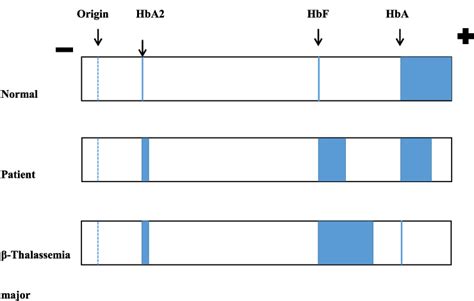 Electrophoresis Pattern Of Our Patient And Comparison With Normal