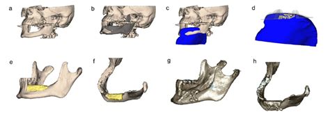 A 3 D Ct Shows The Left Mandibular Defect B Virtual Reconstruction