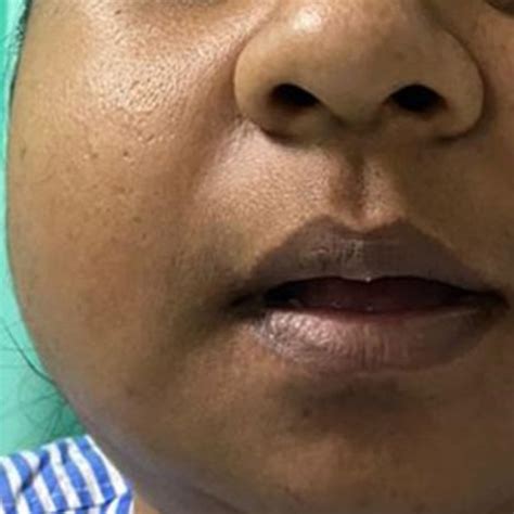 Secrets To A Successful Awake Fibreoptic Intubation Afoi On A Patient