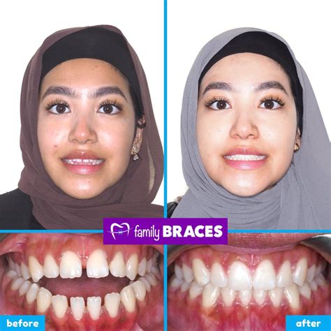 Sebelum Dan Selepas Pakai Braces Lilyenenfrederick