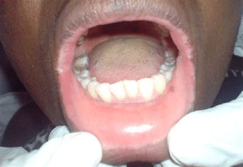 Erythema Of The Oral Mucosa Download Scientific Diagram
