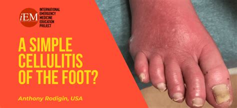 A Simple Cellulitis Of The Foot International Emergency Medicine