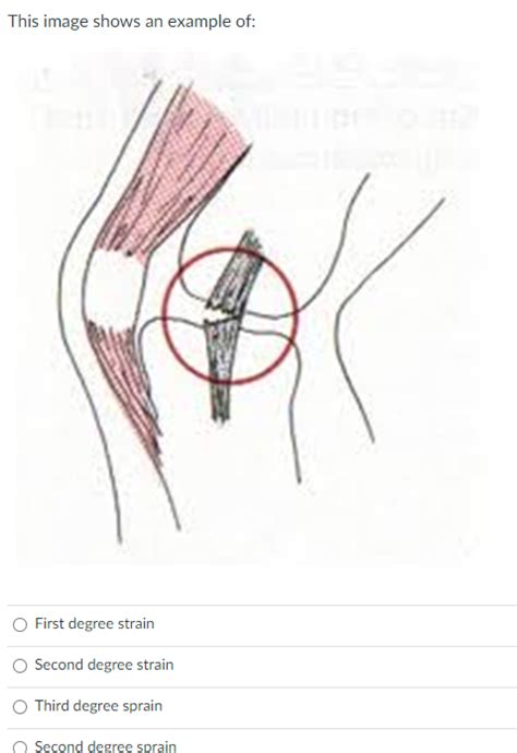 Solved This Image Shows An Example Of First Degree Strain