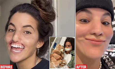 Model 23 Who Had Her Lip Ripped Off By A Pit Bull Shares Her