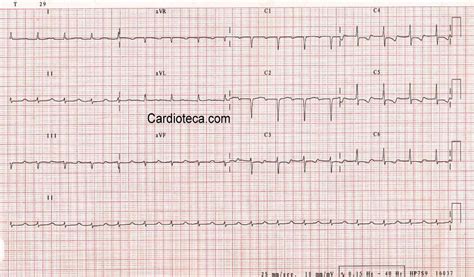 Curso Ecg Taquicardia Auricular Que Simula Taquicardia Sinusal