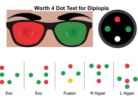 Lesson Differential Diagnoses Of Diplopia Complaints