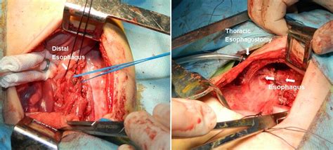 Intraoperative Photographs Showing A The Distal Esophagus And B The Download Scientific