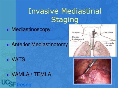 Echoendoscopic Lymph Node Staging In Lung Cancer An Endoscopic Alter