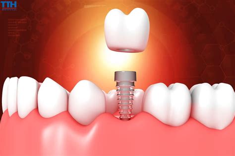 Trồng Răng Implant Và Sức Khỏe Xương Hàm Những Điều Bạn Nên Biết