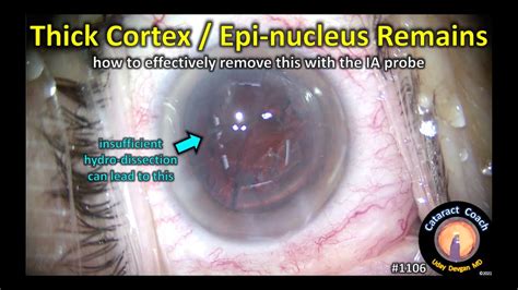 Cataractcoach 1106 Thick Cortex Epi Nucleus Remains How To Remove