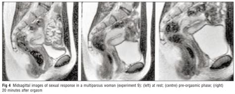 Scientists Have A Saucy Theory For Why These 20 Year Old Mri Sex Scans