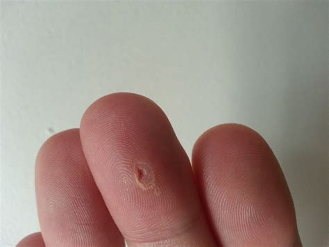 How To Remove A Glass Splinter You Can T See Storables