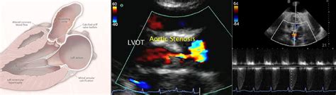 Echocardiography Aortic Stenosis The Role Of Echocardiography In