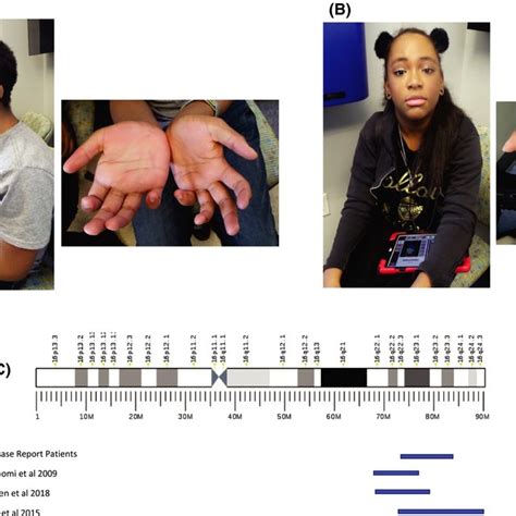 A Photographs Of Patient 1 Showing Dysmorphic Facial Features And 5th